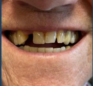 Options For Replacing a Missing Tooth - Lifetime Dental Group ...