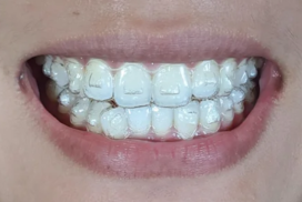 Tips For New Invisalign Patients - Lifetime Dental Group - Michigan ...